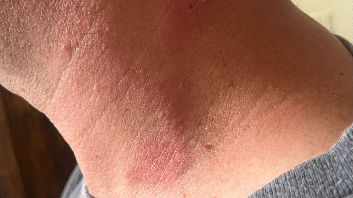 ¿Cuánto tiempo se debe estar atento a las picaduras de ácaros en el ...